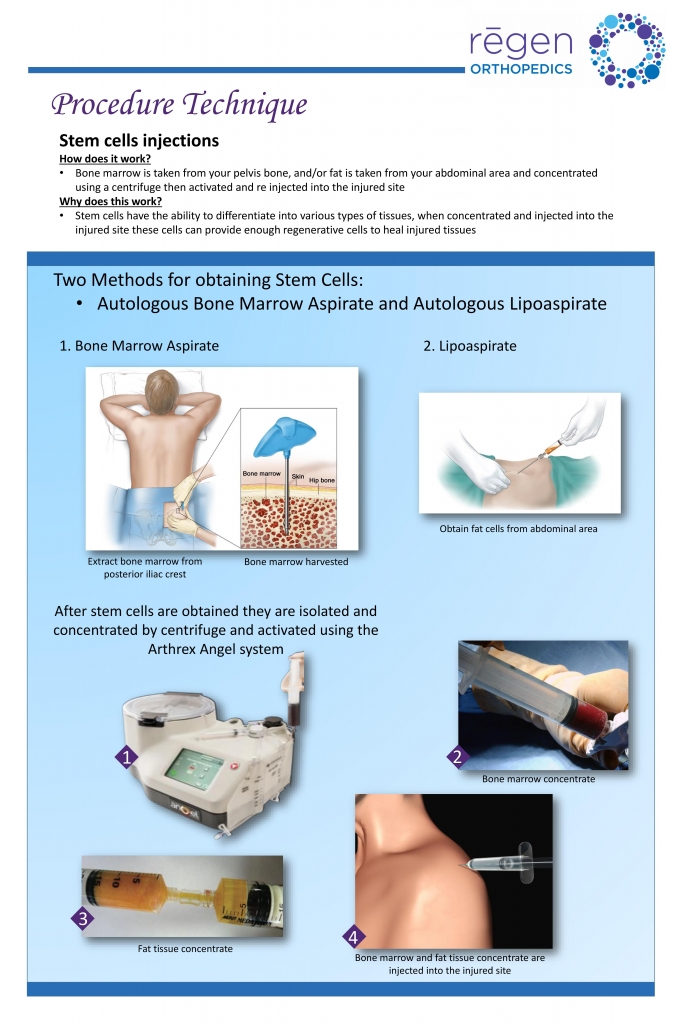 Stem cell injections - how it works - Regen Orthopedics